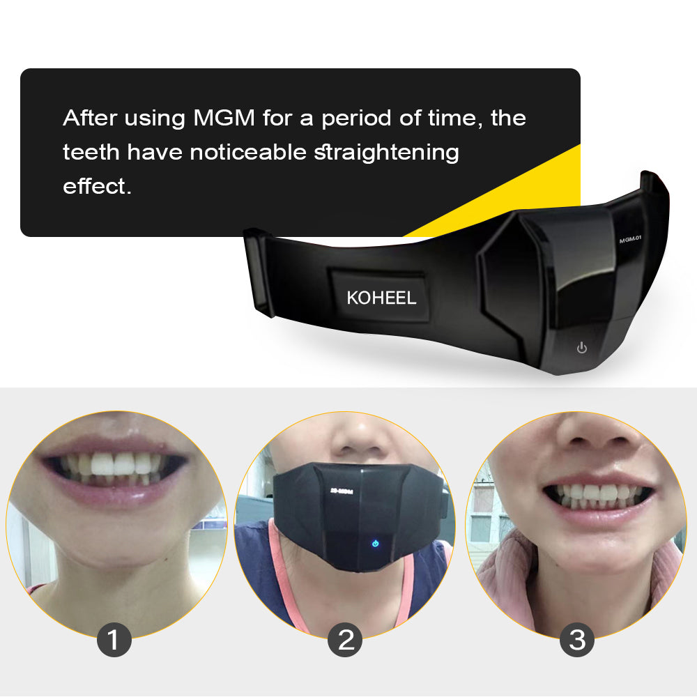 Teeth Straightening at Home for Overbite-Openbite-Gap Teeth. – KOHEEL